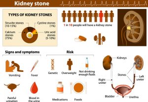 Kidney Stones - Associated Urological Specialists